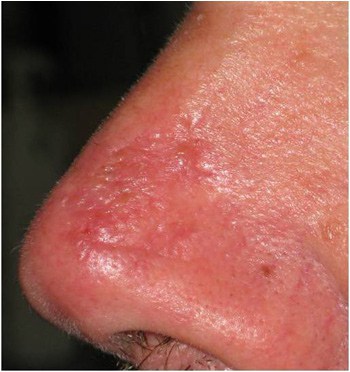 Nose Tip Mohs Defect - Insight Dermatology