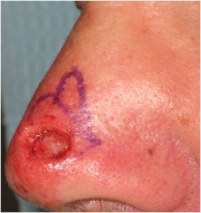 Nose Tip Mohs Defect - Insight Dermatology