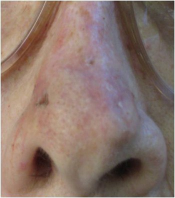 Nose Dorsum Mohs Defect - Insight Dermatology